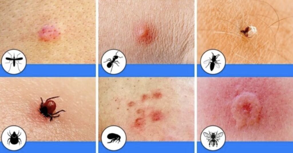 Bijt of steekt het? Zo herken je de insectenbeten (voor het te laat is ...